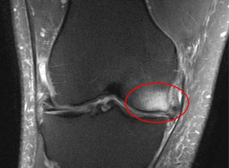 Treating chronic muscle and tendon pain with the TenJet procedure