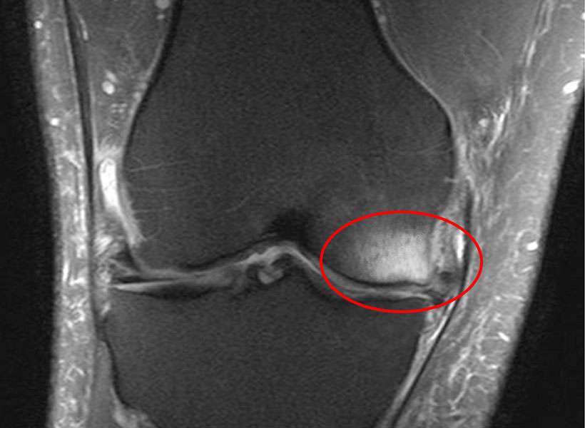 Treating chronic muscle and tendon pain with the TenJet procedure